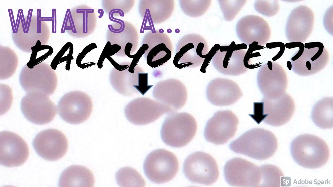 What's a DaCRYocyte?: Peripheral Blood Smear (Hematology ...
