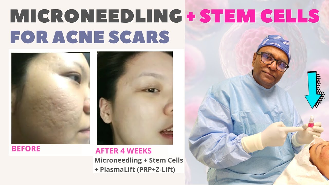 Microneedling + Stem Cells For Acne Scars - YouTube