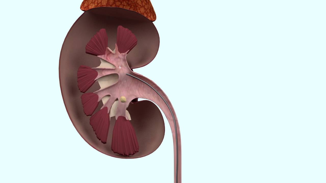 Flexible Ureteropyeloscopy & Lasering a Kidney Stone - YouTube