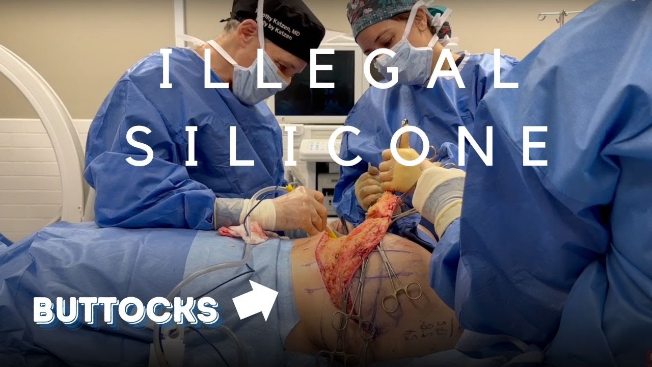 Male Silicone Injection Removal Buttocks (Aquafil, Permanent Filler ...