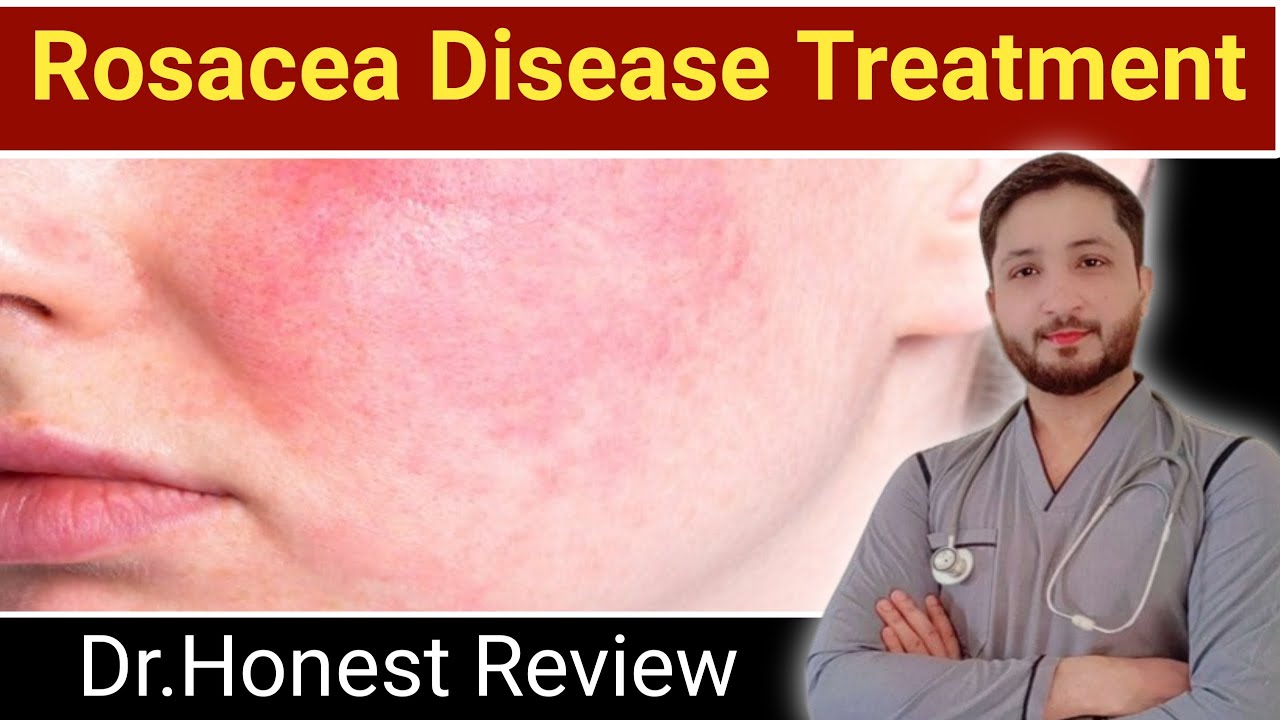 How to get rid of Rosacea infection | face redness treatment | melasma ...