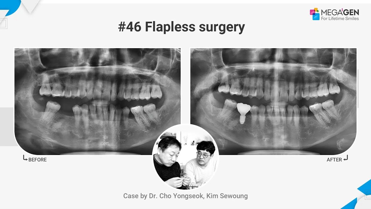 Dr. Yongseok CHO, Sewoung KIM, #46 Flapless surgery and prosthesis ...