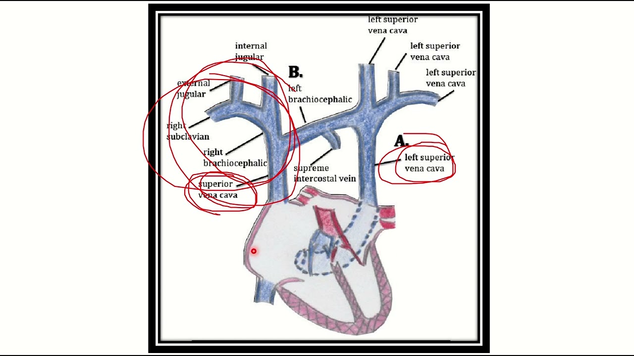 Left sided superior vena cava drains into MRCS question solve (CRACK ...