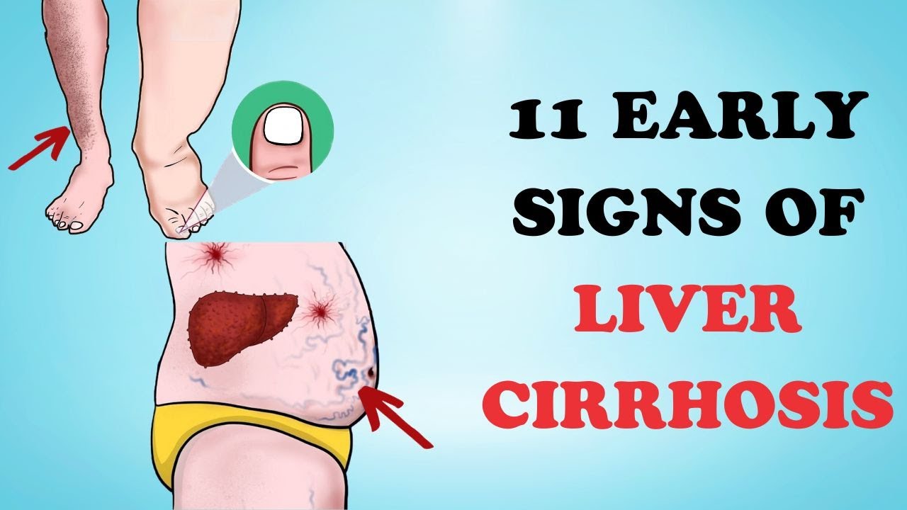 11 Early Signs Of Liver Cirrhosis Healthy Care Youtube