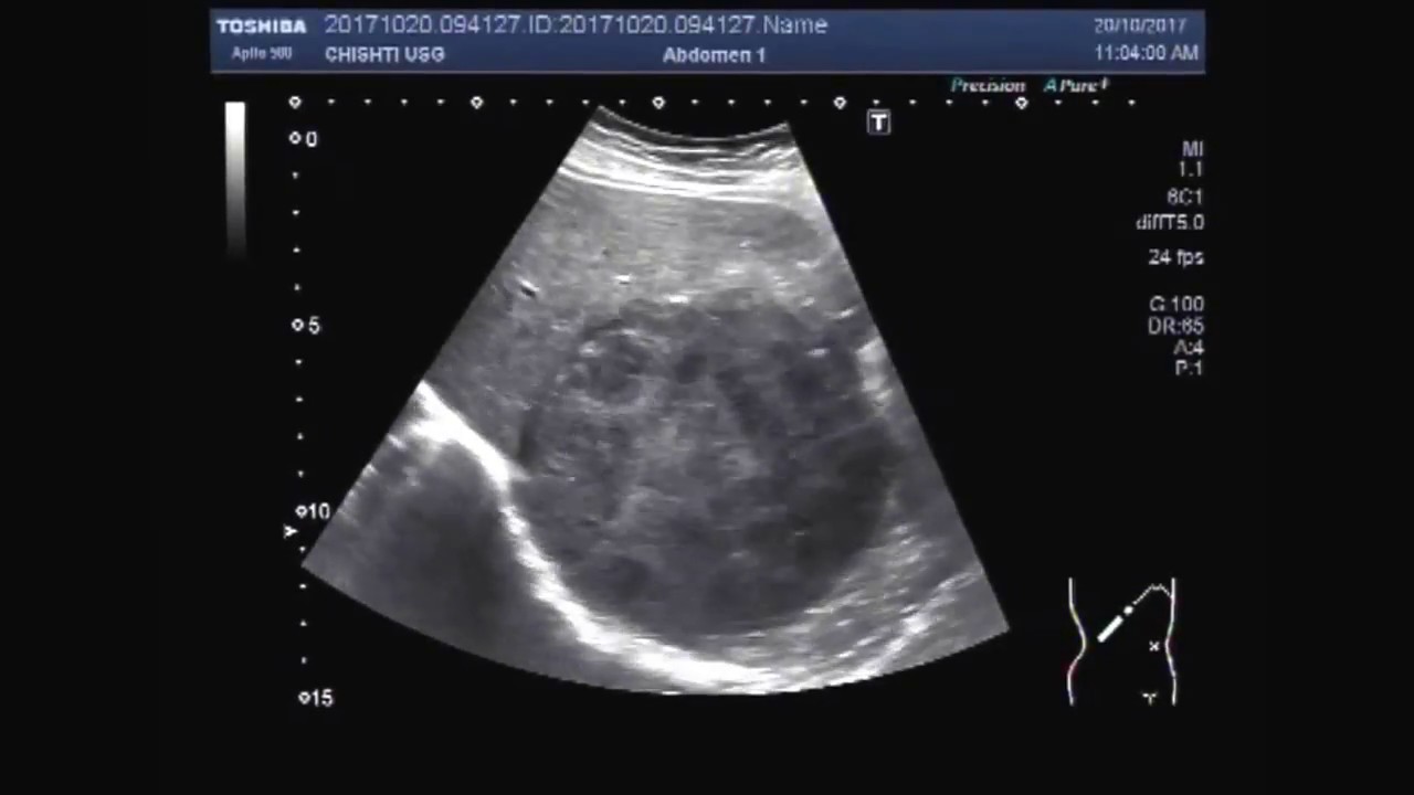 Ultrasound Video showing a large hepatic mass. - YouTube