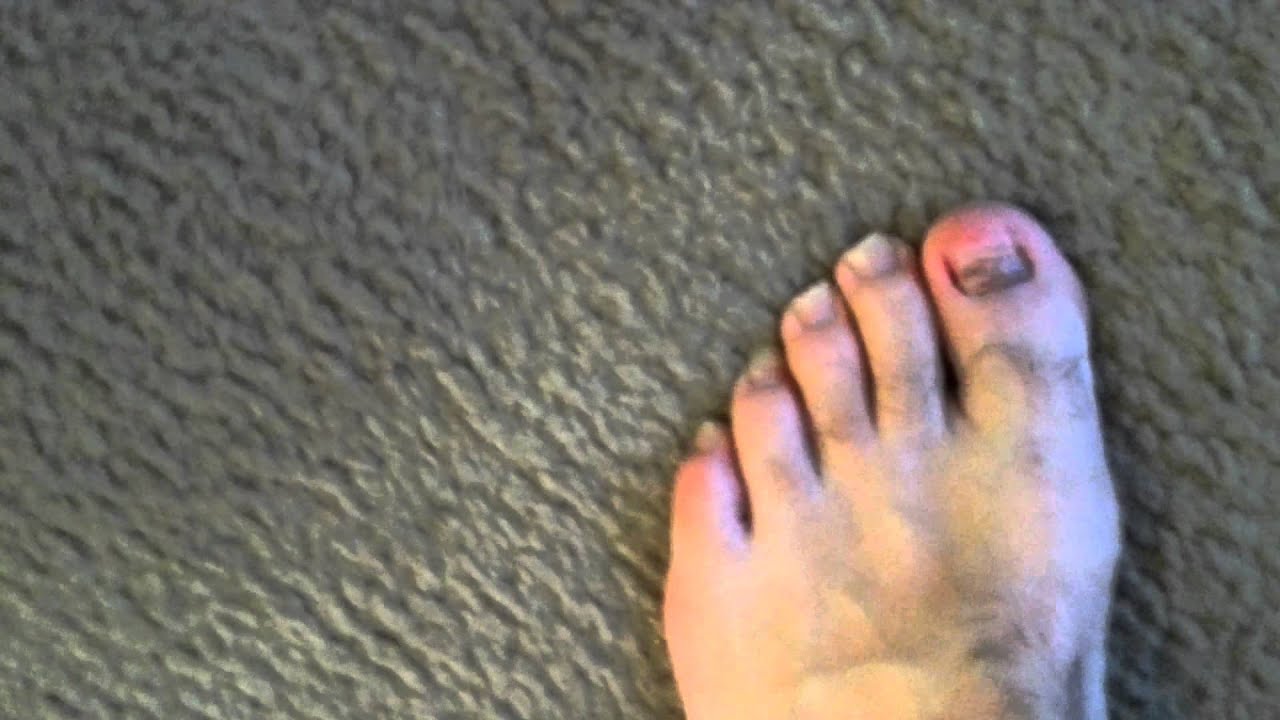 Toe nail pulled off with pliers - YouTube