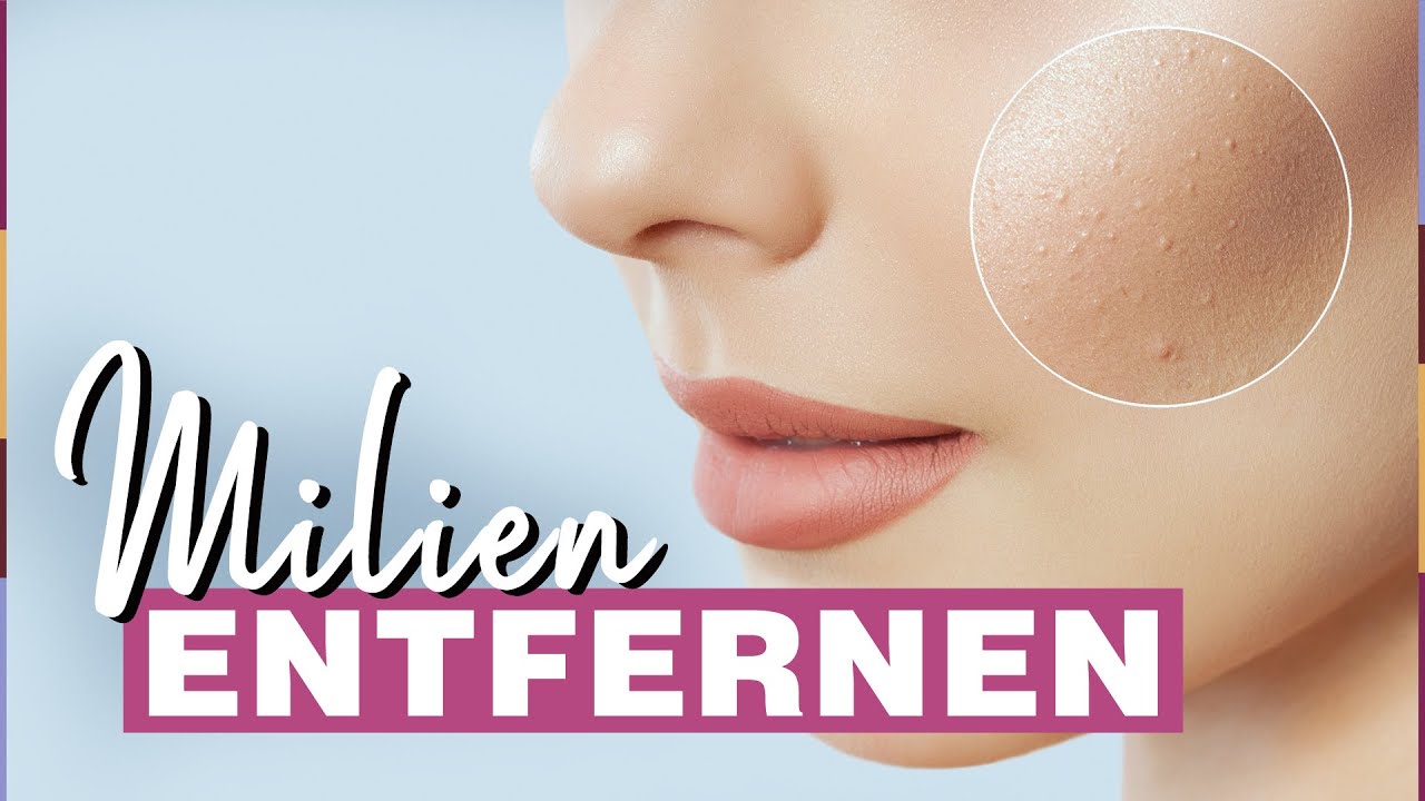 Milien entfernen: So werdet ihr die Grieskörner unter den Augen los ...