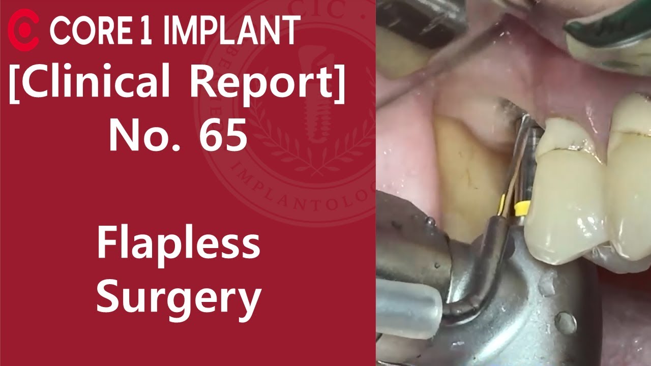 [CYBERMED Clinical Report] #16 Implant placement with Flapless surgery - YouTube