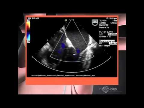 Neochord Corporate Video - YouTube