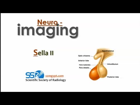 Imaging of the Sella (II) (DRE) Prof. Mamdouh Mahfouz - YouTube
