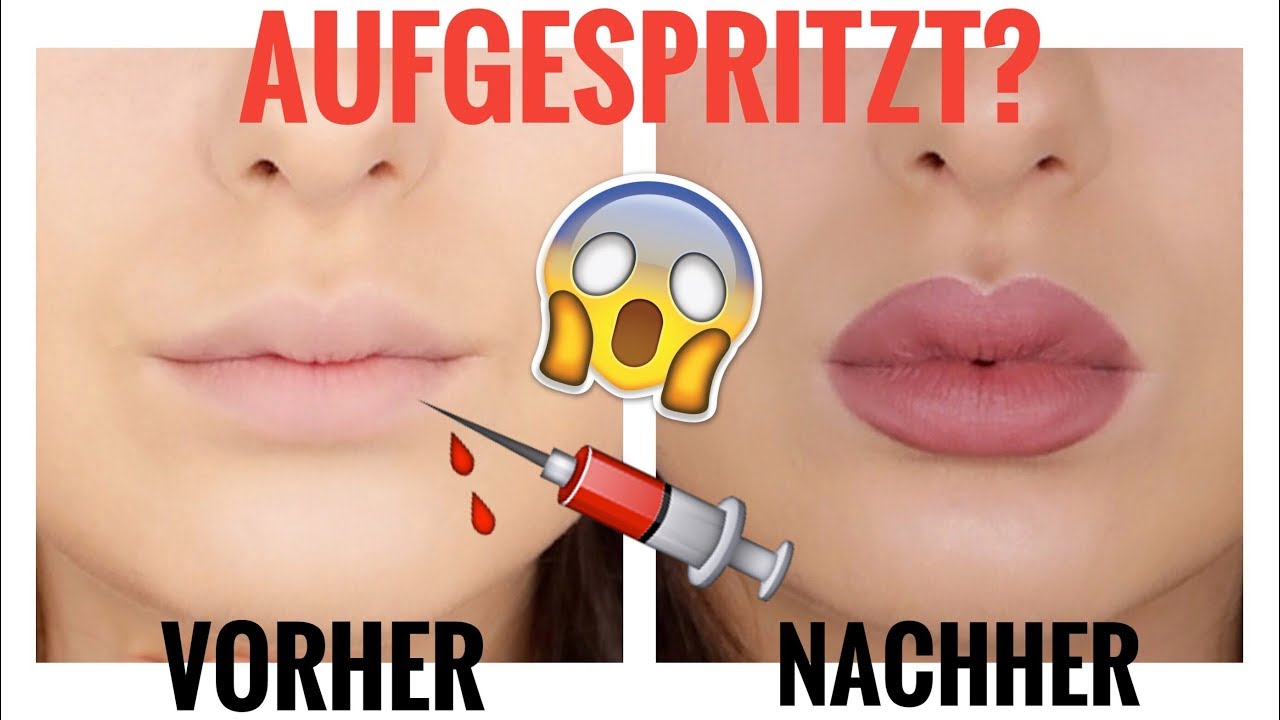 Fabelhafte Aufgespritzte Lippen Extrem Bild