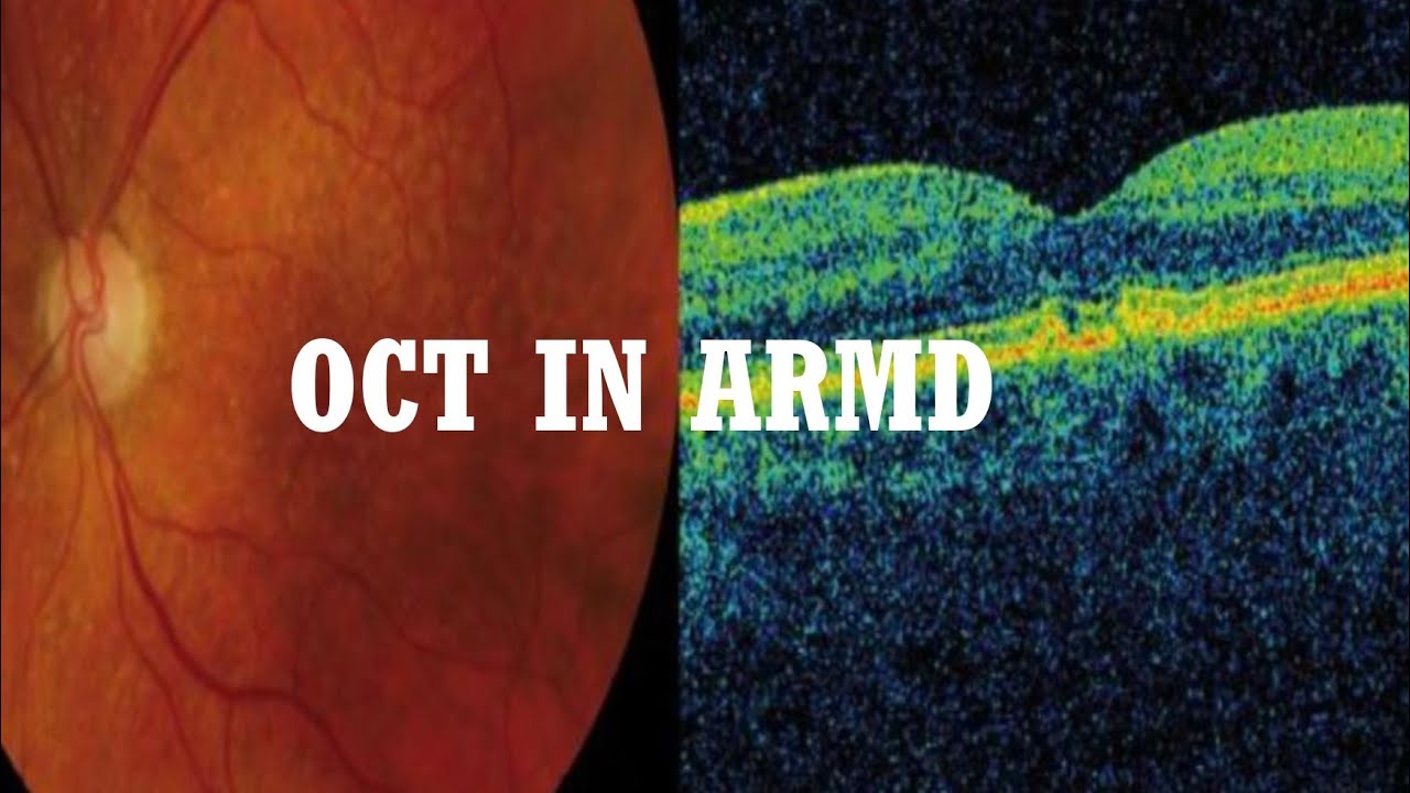 OCT in AMD( Age related macular degeneration - YouTube