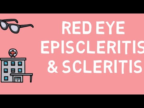 Red eye- Episcleritis and Scleritis - YouTube