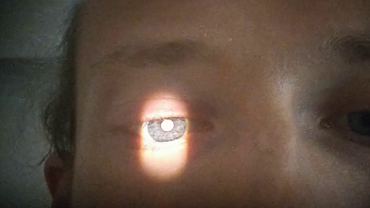 Video H: Dynamische Skiaskopie bei Anisometropie - YouTube