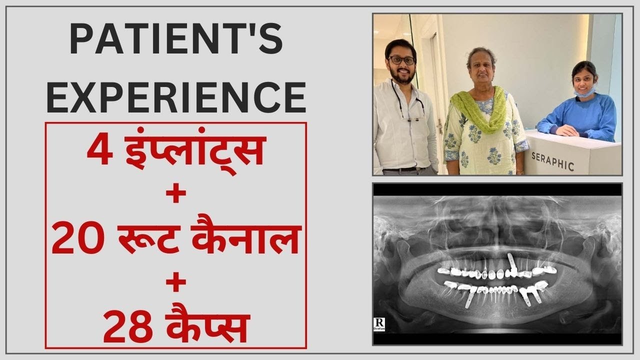 4 Implants + 20 Root Canal + 28 Caps | Happy patient Review | Dr Ankit ...