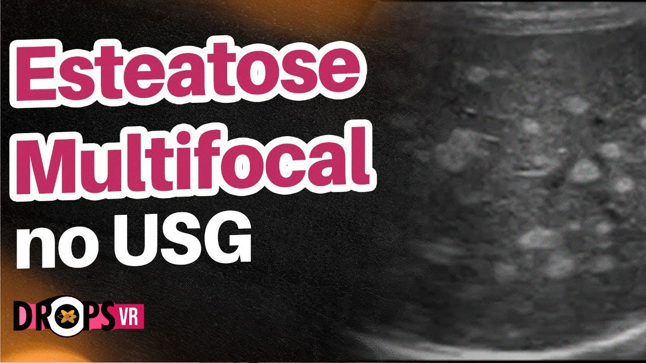 ESTEATOSE MULTIFOCAL NO USG I VOCÊ RADIOLOGISTA - YouTube