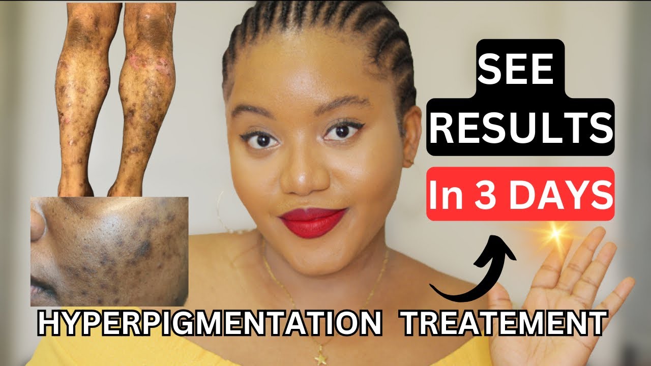 HOW TO FADE HYPERPIGMENTATION FAST 💨 | COMPLETE BODY KIT + FULL ROUTINE ...
