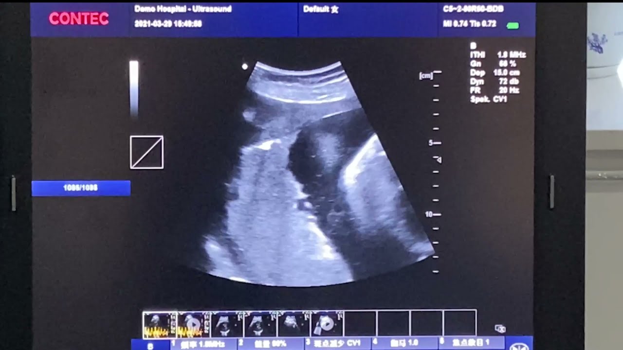 CONTEC CMS1700B Color Doppler Ultrasound Diagnostic System Clinic ...