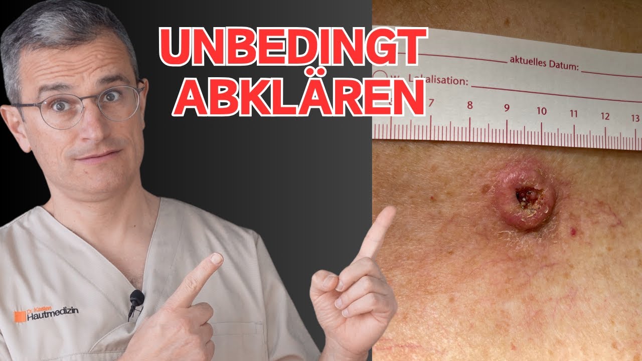 Keratoakanthom: Was Sie über diesen Hauttumor wissen müssen! | Dr. Kasten Hautmedizin - YouTube