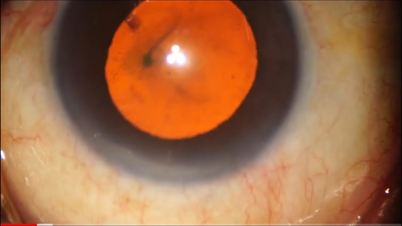 Acg Persistant Hyaloid Artery Mittendorf Dot Dr Ramakrishna Tadanki Youtube