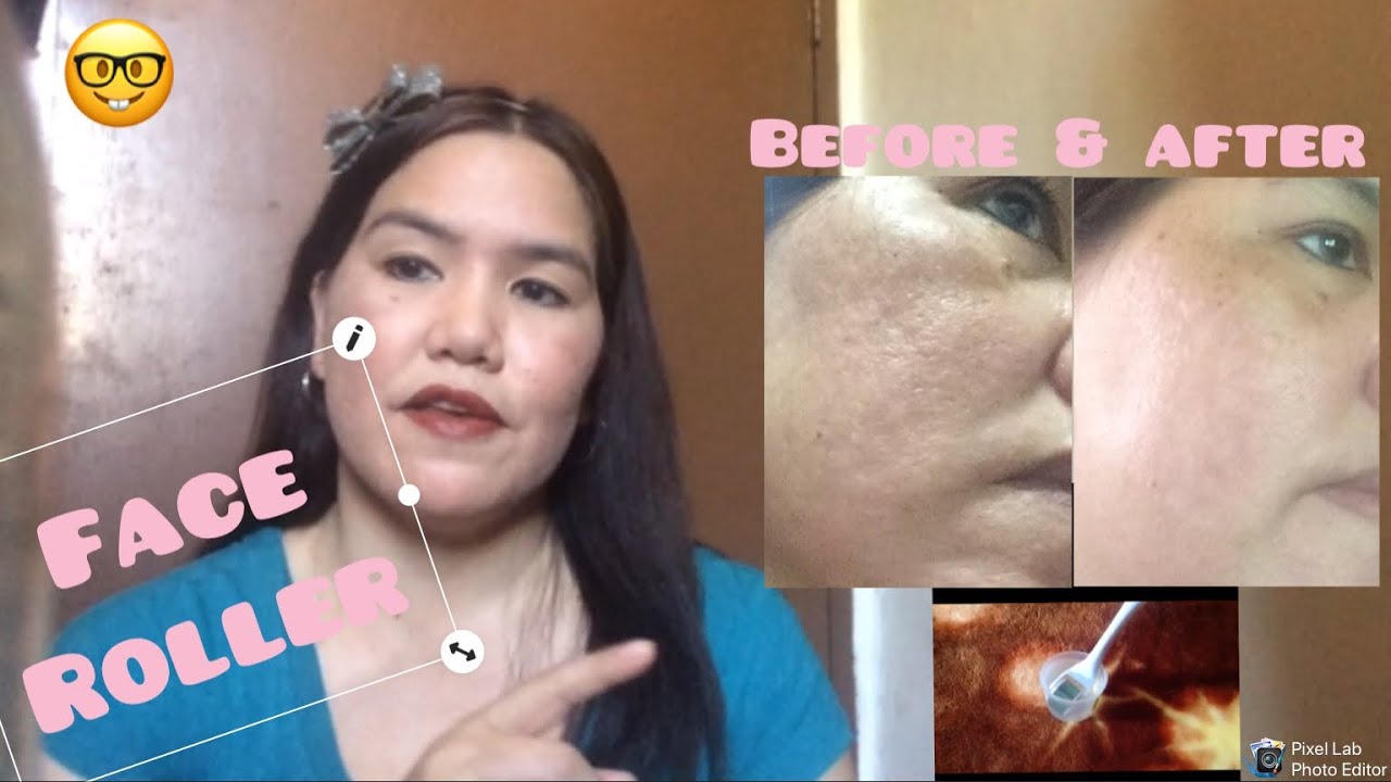 FACE ROLLER FOR ACNE SCAR/PIMPLE MARK & MUCH MORE - YouTube