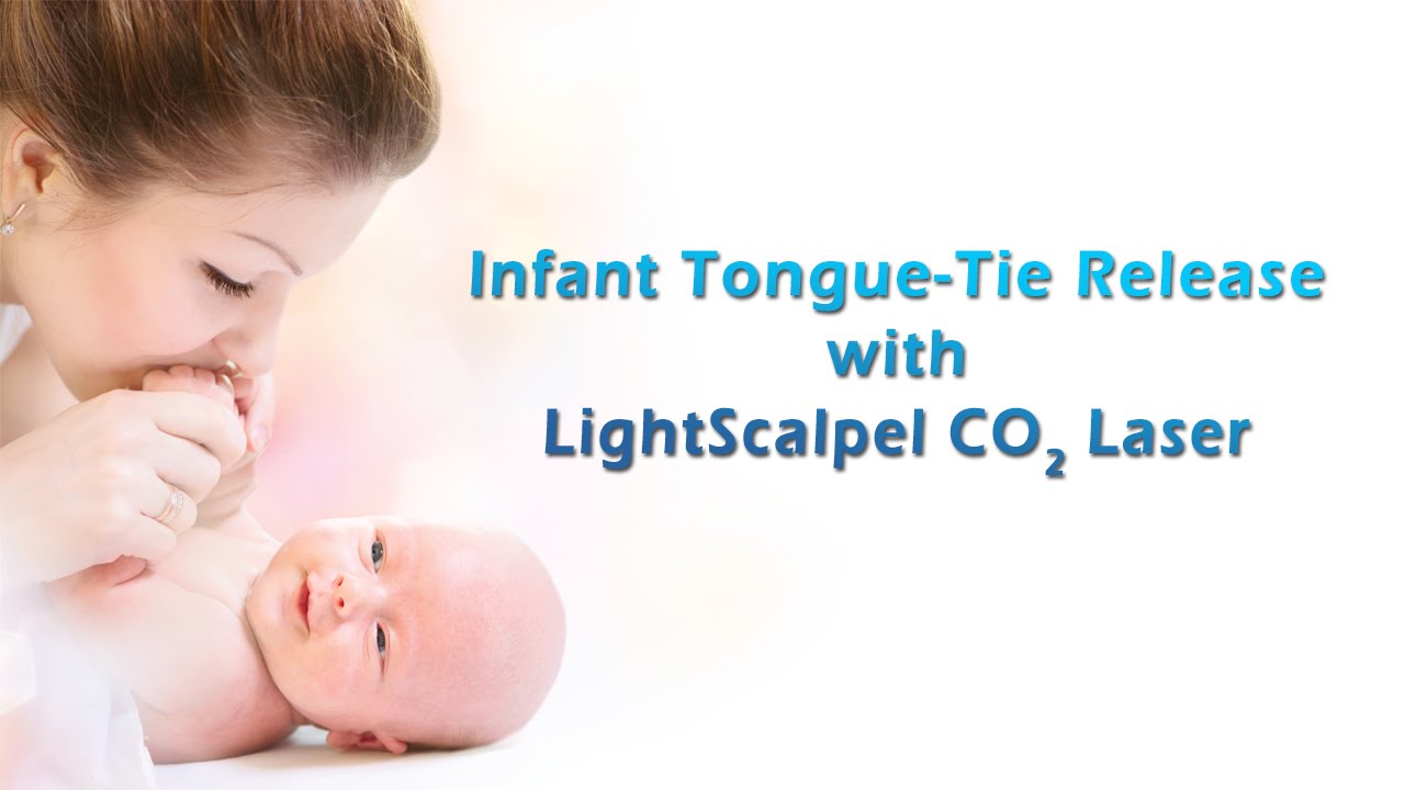 Infant Laser Frenectomy (Tongue-Tie Release) - LightScalpel Laser - YouTube