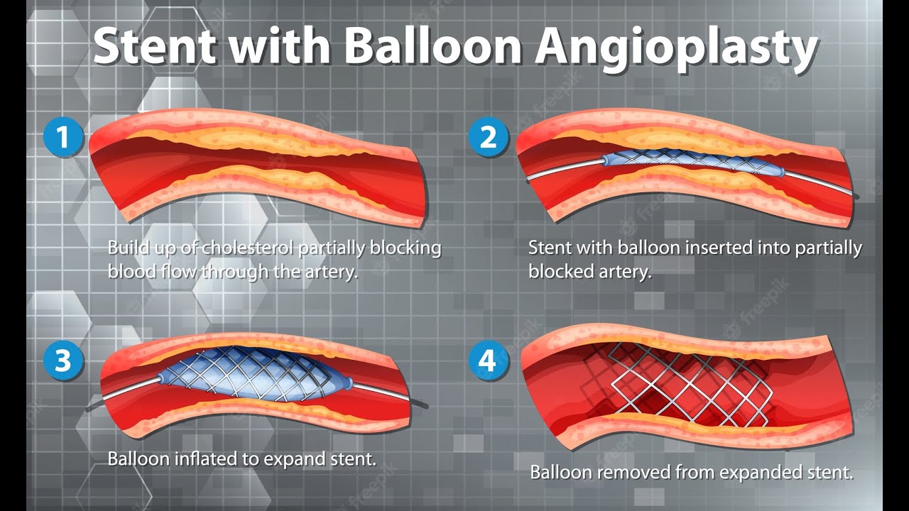 How stenting procedure is done ( Angioplasty)? - YouTube