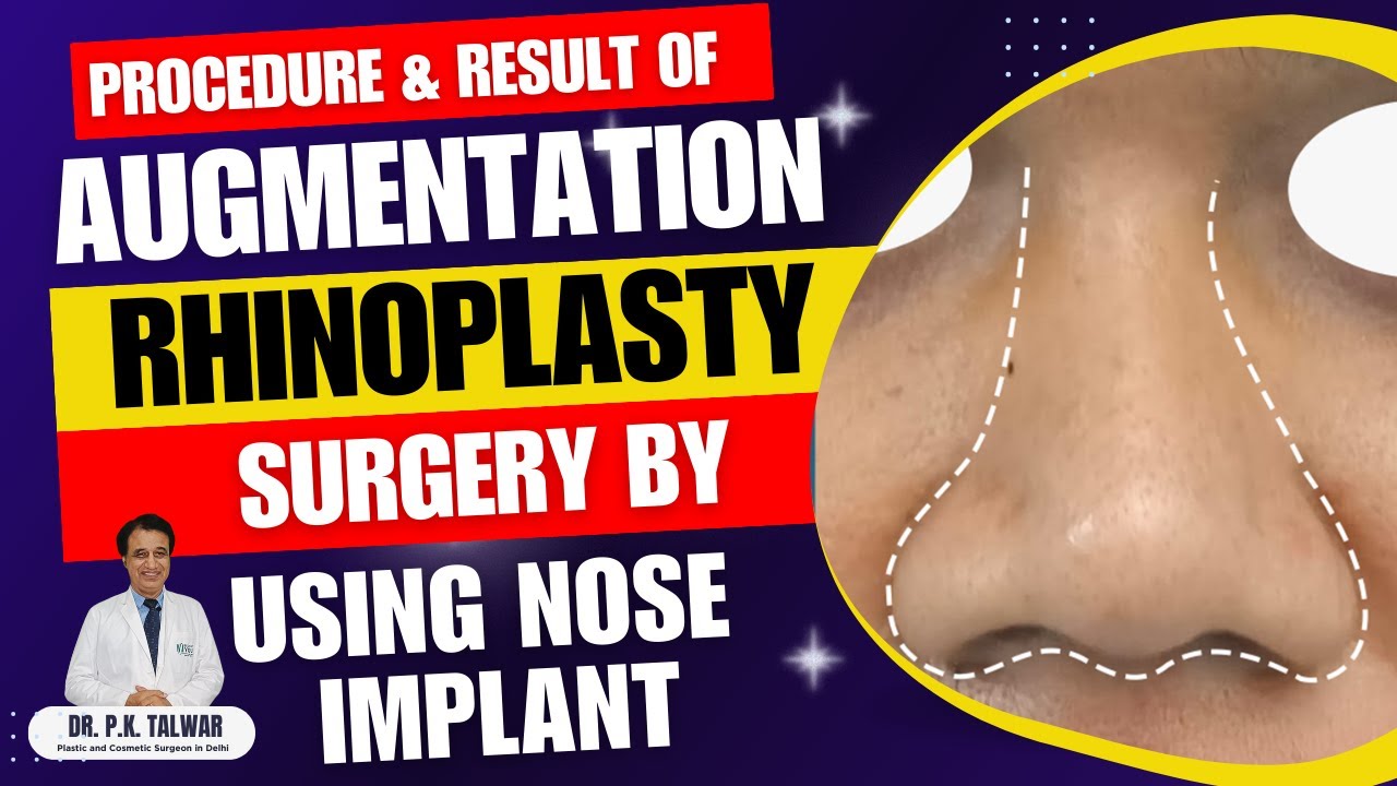 Augmentation Rhinoplasty surgery by using Nose Implant | Surgery ...
