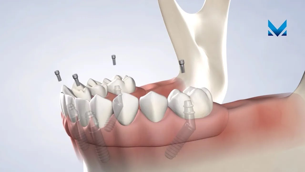 All-on-4 Treatment in Ann Arbor, Adrian, Dexter, and Plymouth, MI ...