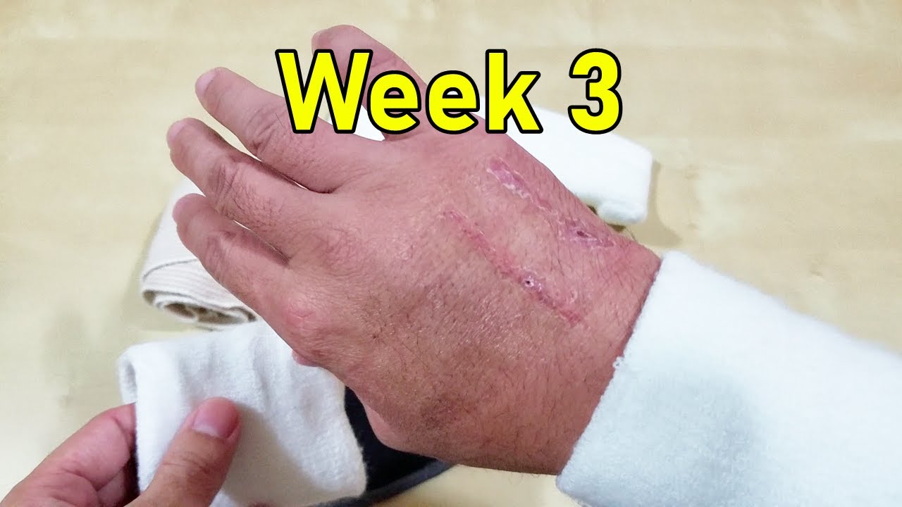 Week 3 Soft Callus 🤕🖐🦴 @JamesBondJB007 - YouTube