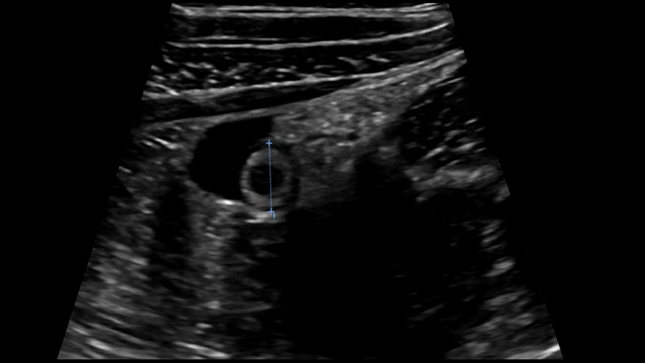 Acute appendicitis-Laparoscopic appendectomy - YouTube