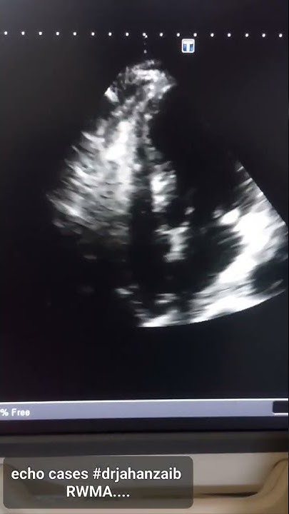 echo cases/RWMA in IHD - YouTube