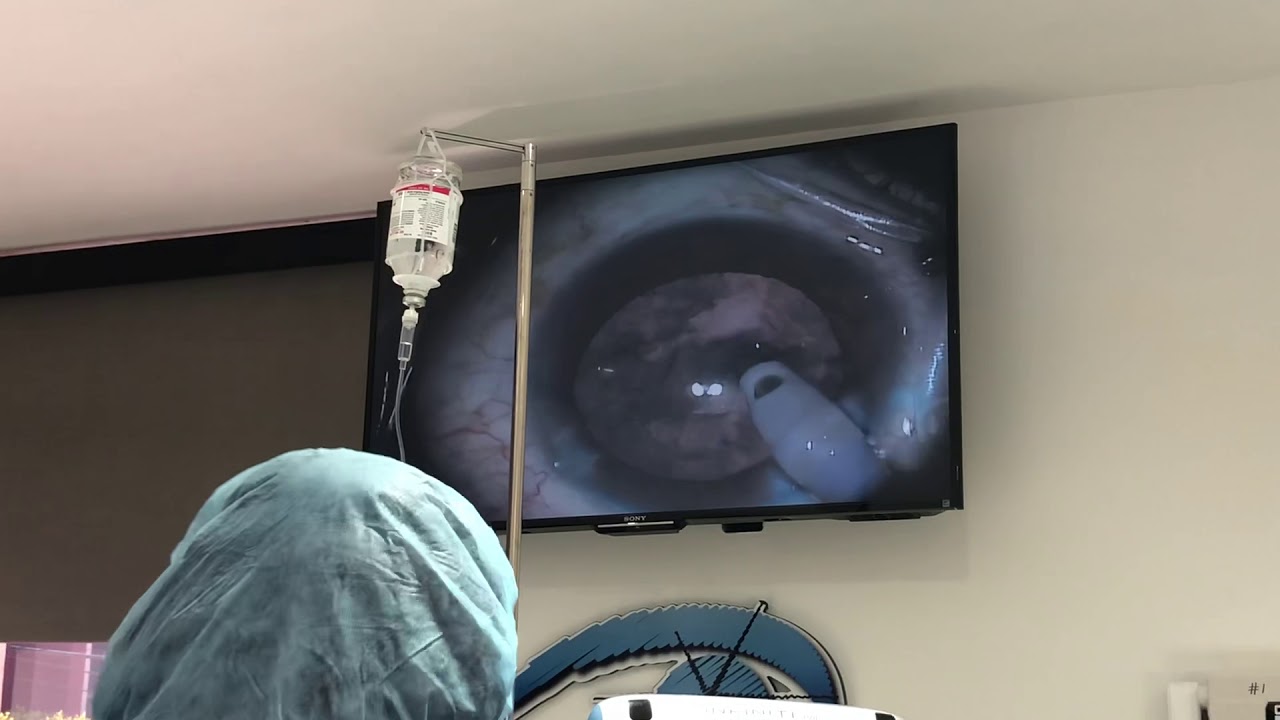 Posterior Subcapsular Cataract Surgery & Multifocal Lens Implantation ...