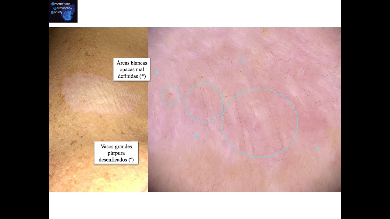 Dermatoscopia en Dermatologia general - Morfea y Liquen escleroso - Dra ...