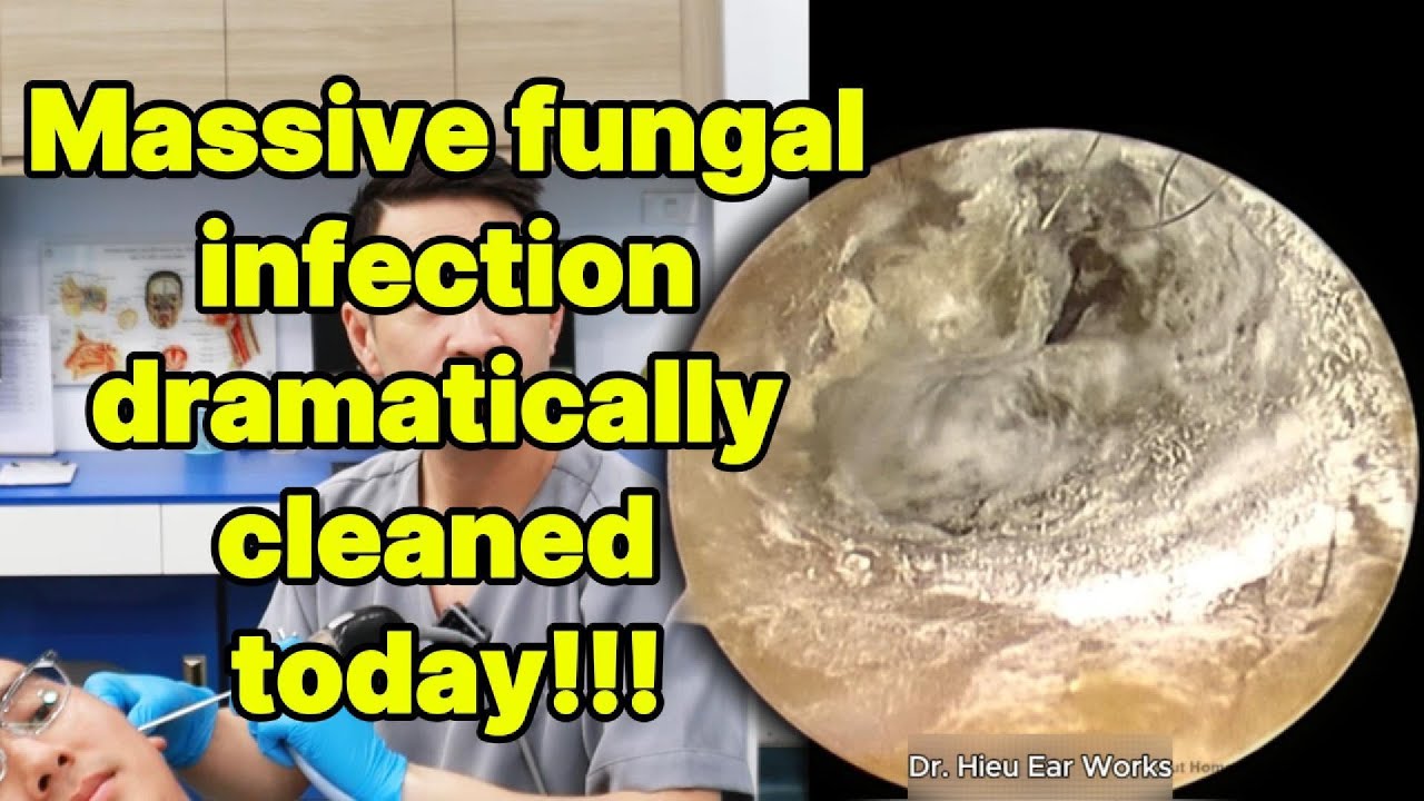 Massive fungal infection dramatically cleaned today | ear cleaning ...