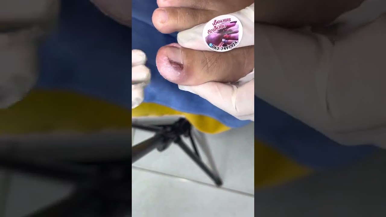 Ep_4251 Ingrown toenail removal 👣 อื้อหือ..คุณน้อง 😁 (clip from ...
