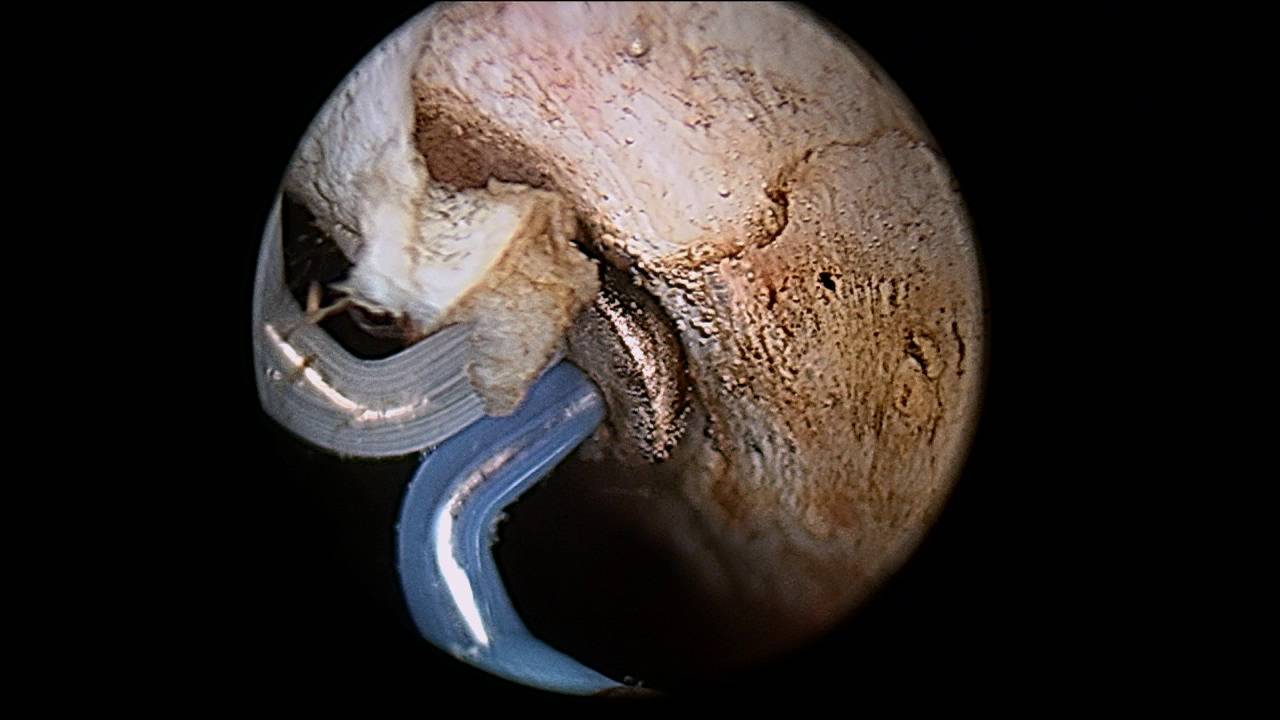 Bipolar “Button” Plasma Vaporization of the Prostate (BPVP) 2 - YouTube