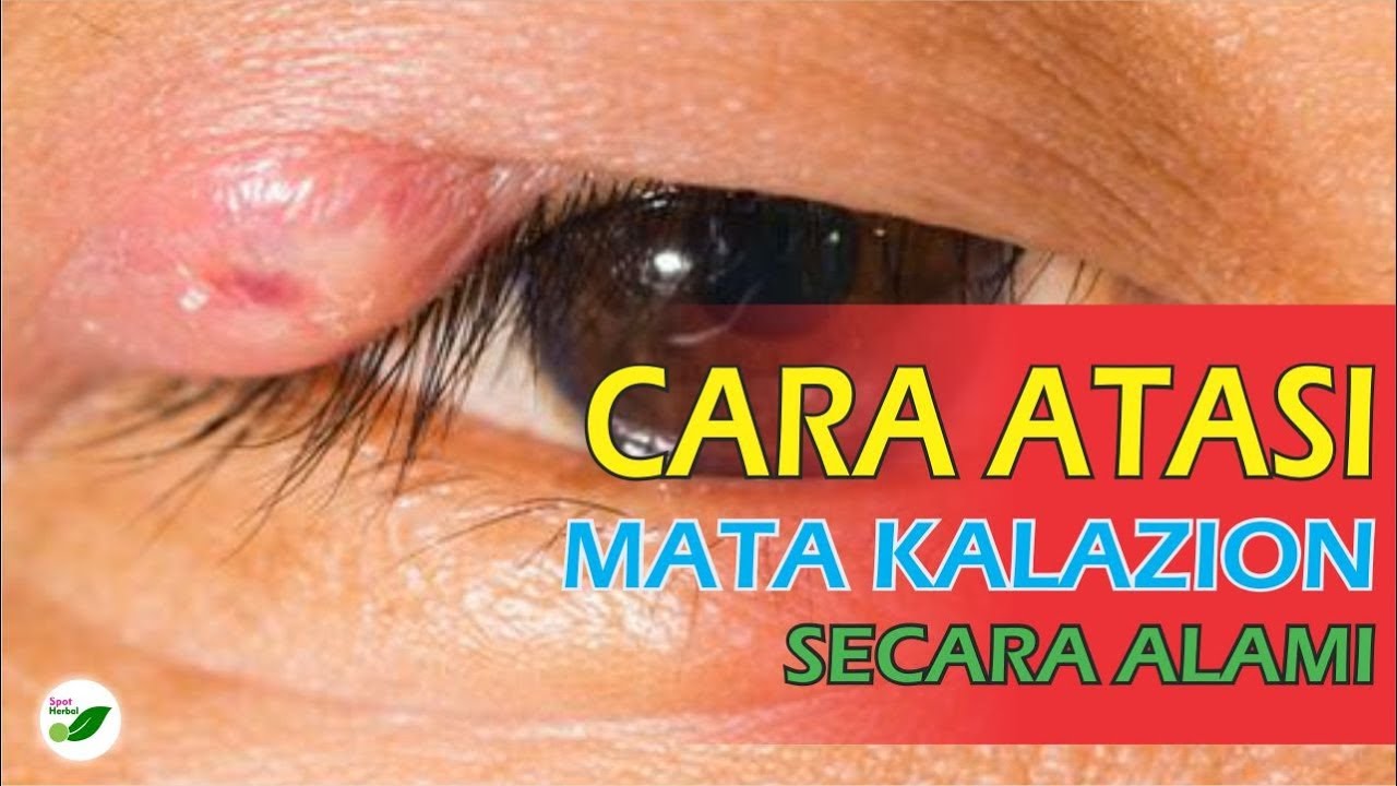 Cara Mengatasi Mata KALAZION Tanpa OPERASI Hanya Dengan Konsumsi ...