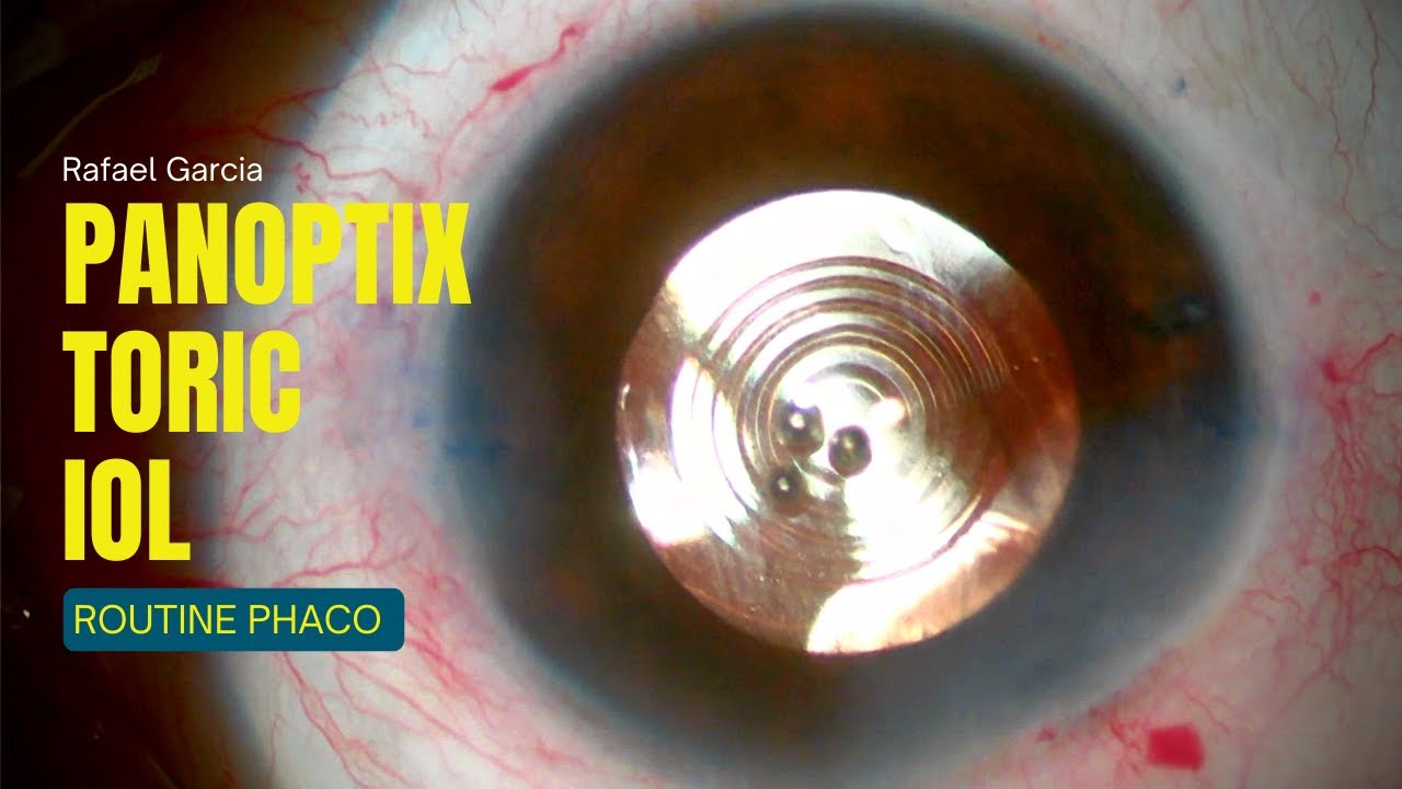 Panoptix Toric IOL - YouTube