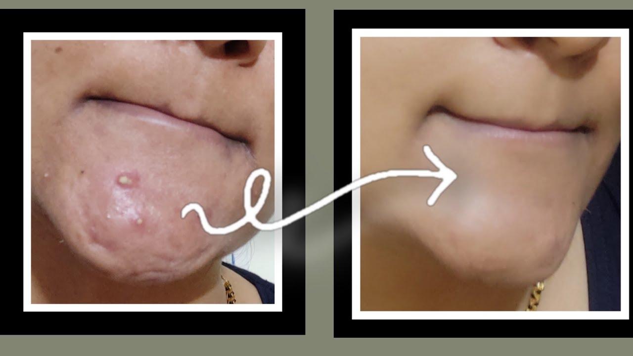 How I Cleared Puss Filled Acne / Pimple In Just One Day || Erytop ...