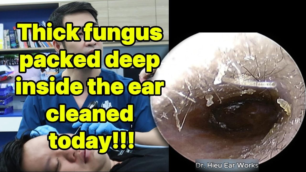 Thick fungus packed deep inside the ear cleaned to | ear cleaning ...