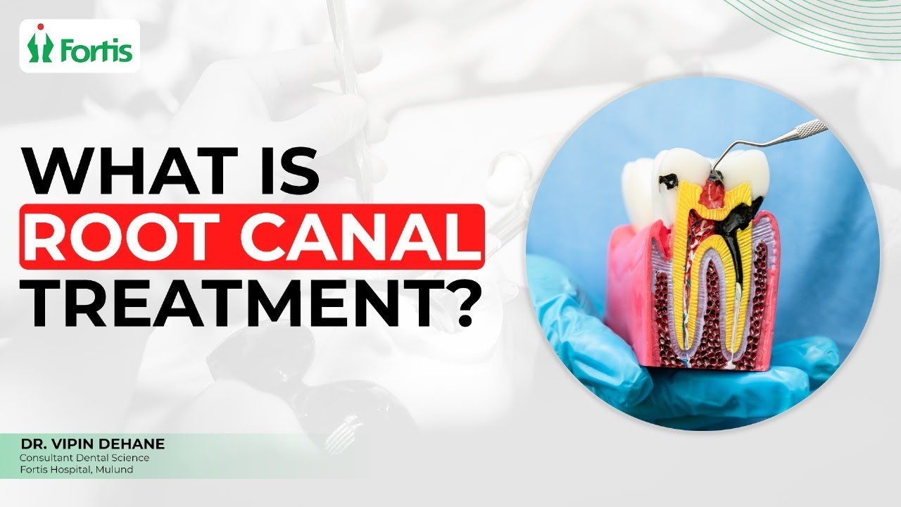 What Is Root Canal Treatment? | Why Do You Need a Root Canal? | MUL ...