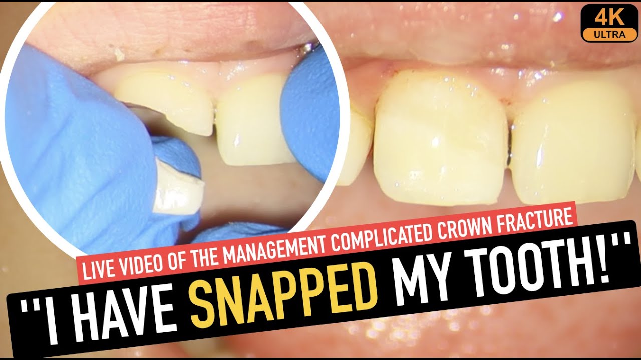 COMPLICATED CROWN FRACTURE MANAGEMENT | 4K Resolution - YouTube
