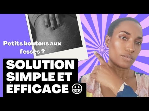 Comment traiter les petits boutons/acnés de fesses - Comment traiter l'acné de fesses - YouTube