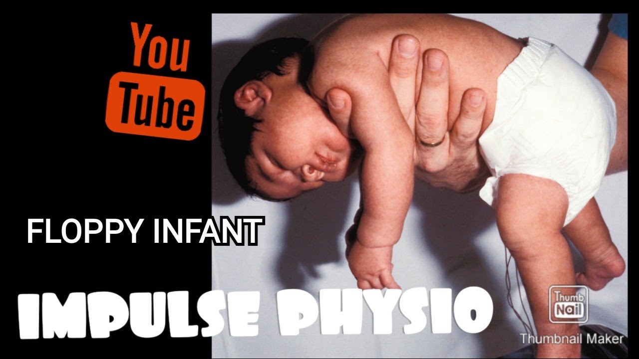 WHAT IS FLOPPY INFANT | IMPULSE PHYSIO - YouTube