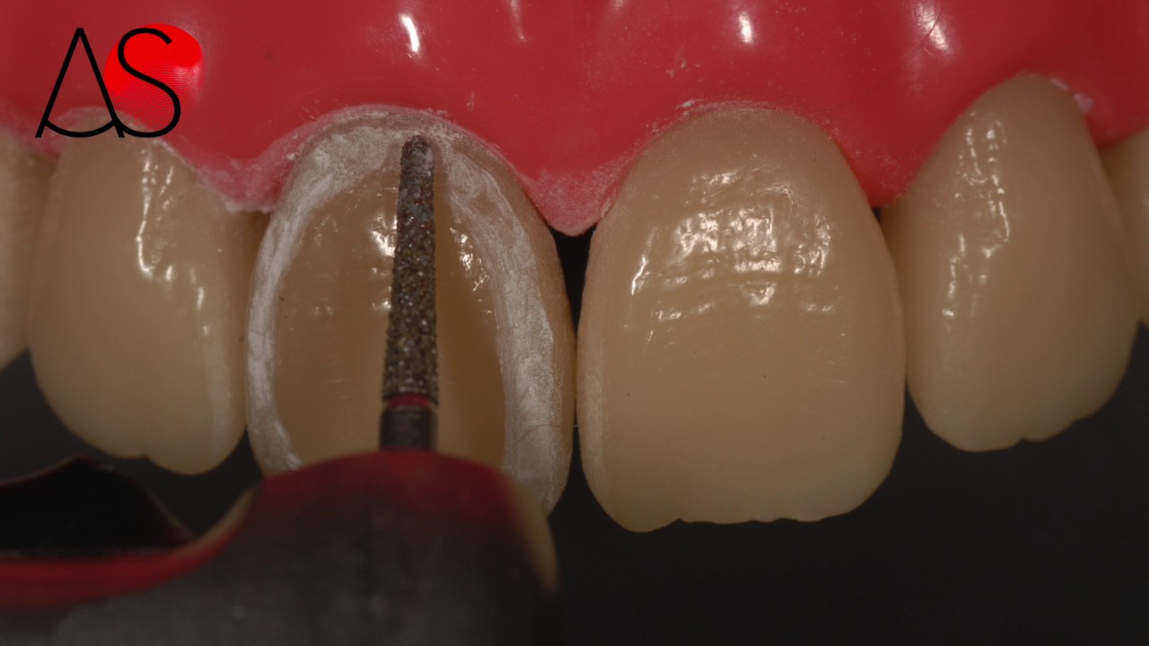 Preparo em dente escurecido para restauração direta - YouTube