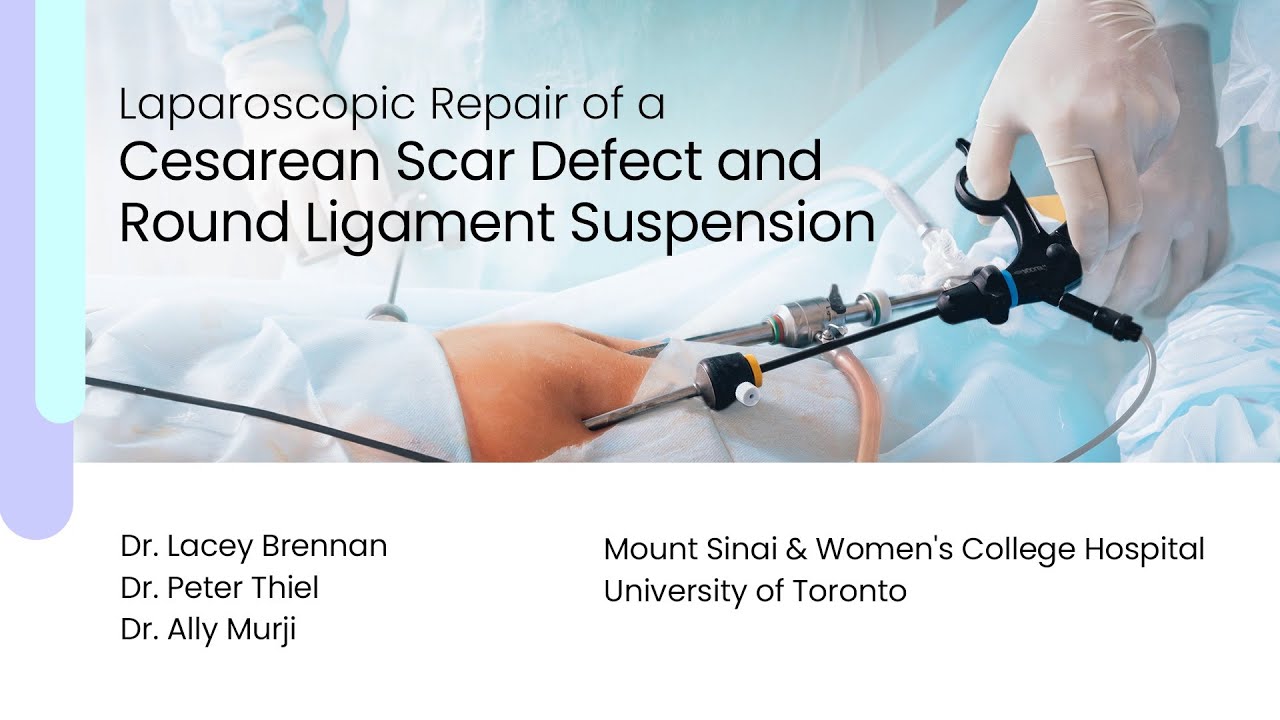 Laparoscopic Repair of a Cesarean Scar Defect and Round Ligament ...