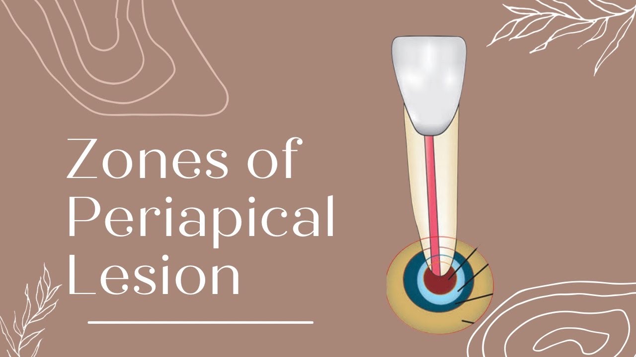 PERIAPICAL LESIONS| ZONES OF PERIAPICAL LESION | ENDODONTICS - YouTube