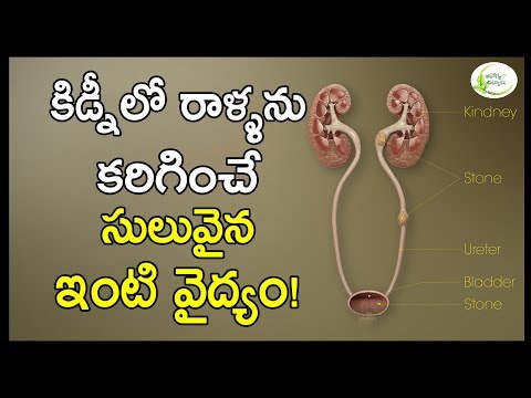 కిడ్నీలో రాళ్ళను కరిగించే సులువైన ఇంటి వైద్యం! | Remove Kidney Stones Forever With One Home Remedy