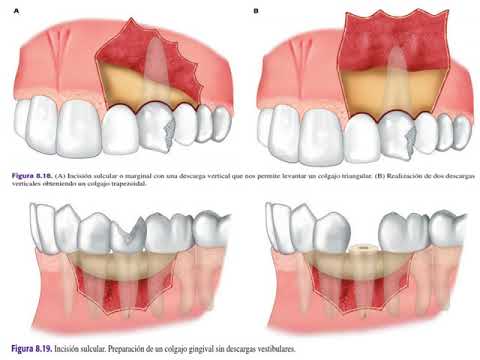 Tema: alveolectomía - YouTube